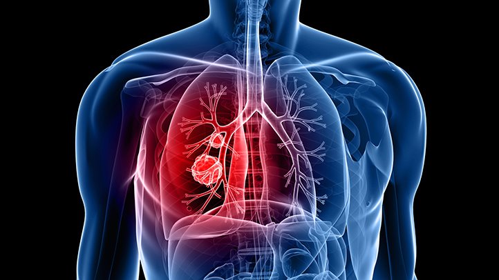 Get ahead of lung cancer screening with Dr Mamta Ruparel’s recent ...